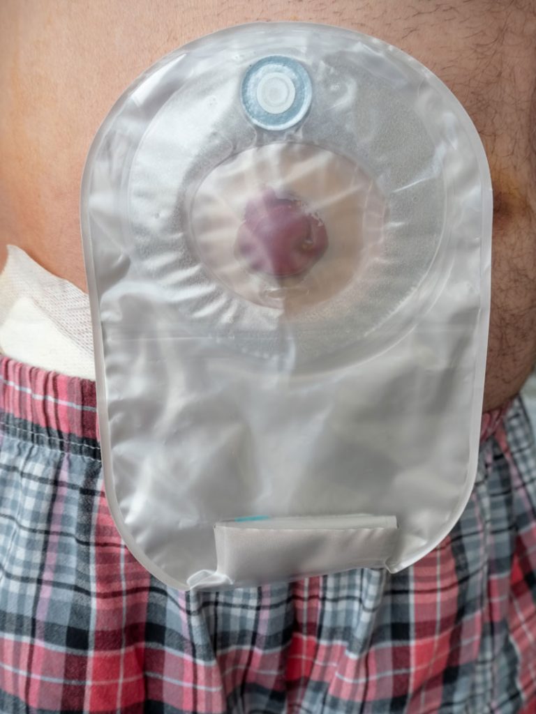 Ostomy Wound Care