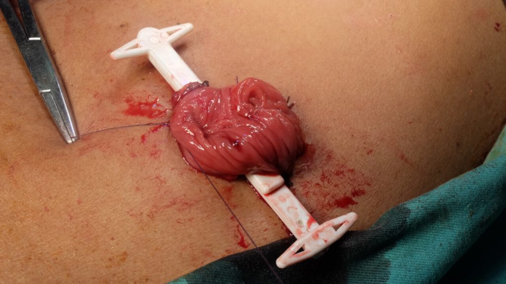 Overview about Loop Colostomy | Ostomy Association of Boston