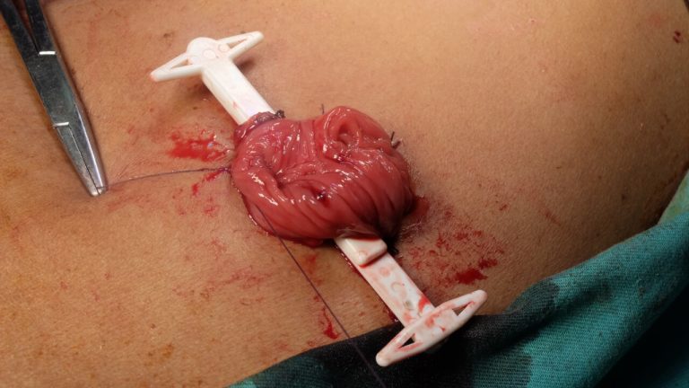 Overview about Loop Colostomy | Ostomy Association of Boston