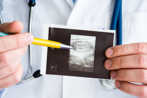 small bowel intussusception diagnosis | Ostomy Association of Boston